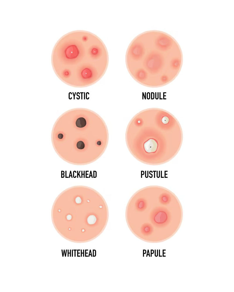 Pickel: Ursachen, Auslöser & was wirklich hilft | Hautwissen – DOC ...