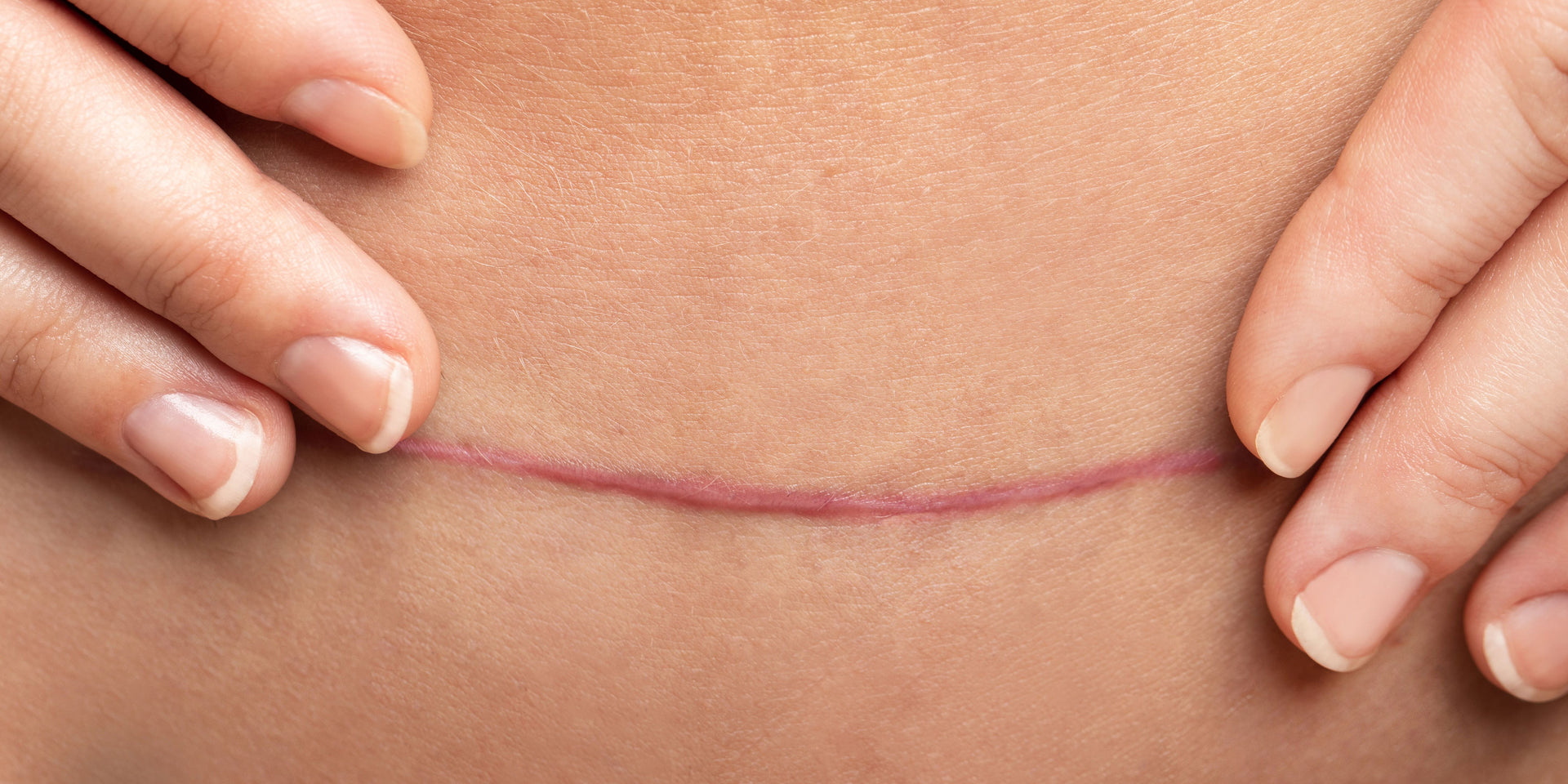 Narben richtig pflegen: Was wirklich hilft gegen Aknenarben, Keloide ...